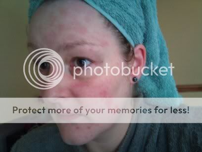 Wine Rash! | BabyCentre